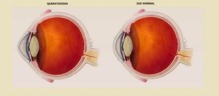 Conocé la enfermedad de ojos en forma de cono - De La Bahia